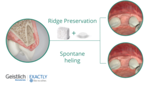 Ridge Preservation | Dent-Med Materials